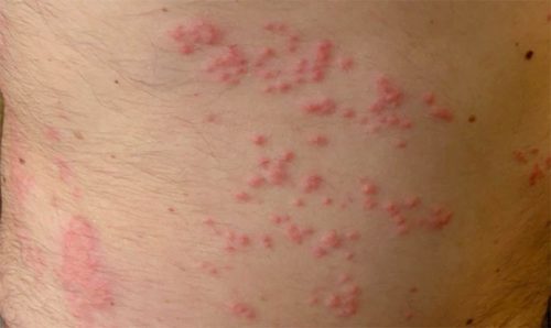 Sea Lice Make It To Jersey Shore Waters - Jersey Shore Online